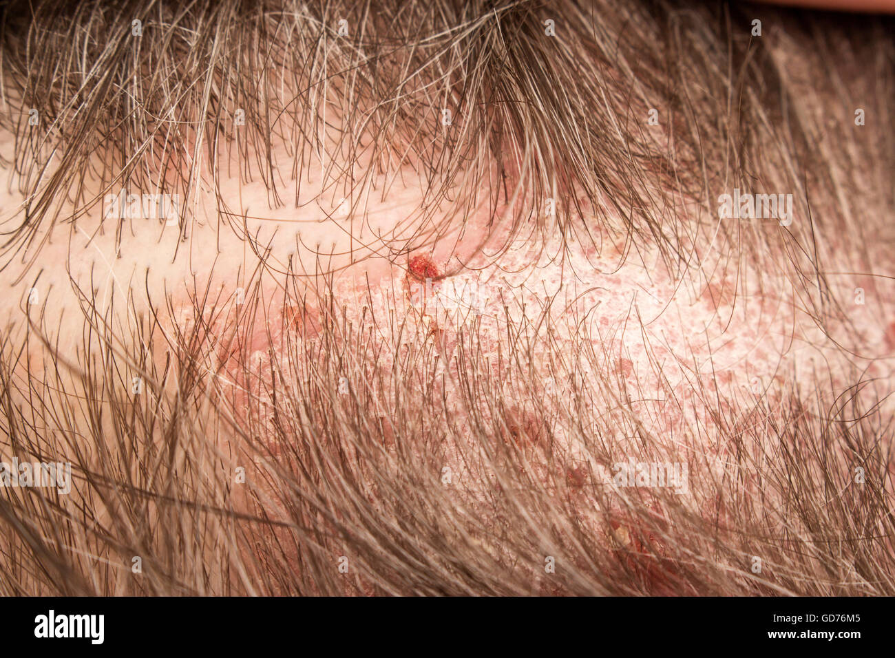 Psoriatic Skin High Resolution Stock Photography and Images - Alamy
