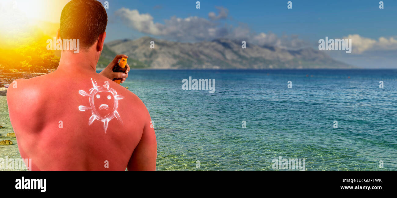 Man with sunburned skin and ocean beach with sunset Stock Photo - Alamy