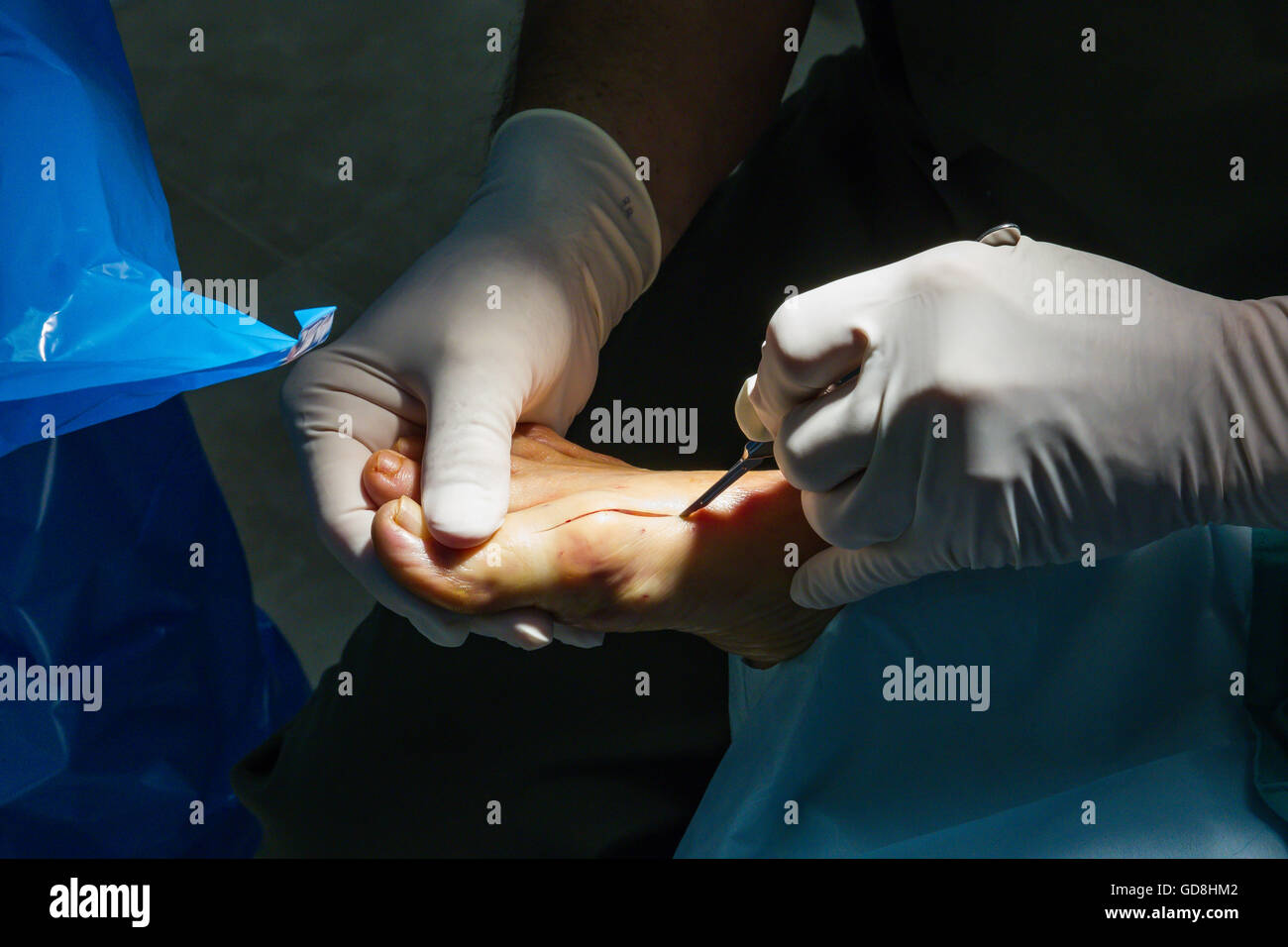 Cut Open Foot Surgery