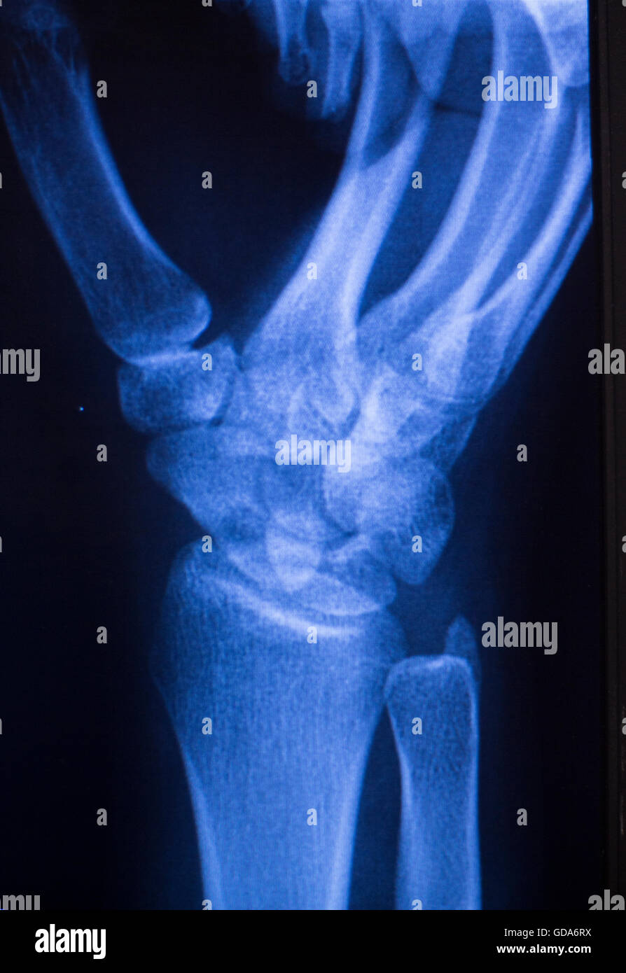 Hand, thumb, wrist and fingers xray traumatology and orthopedics test ...