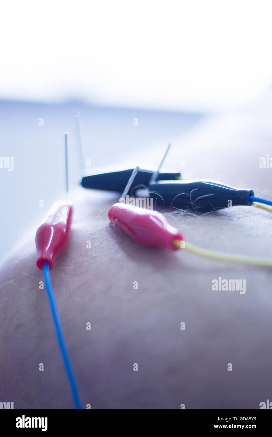Dry needling electroacupunture needles used by acupunturist ...