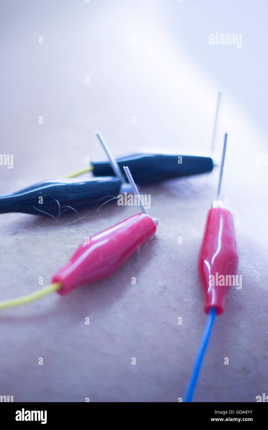 Dry needling electroacupunture needles used by acupunturist ...