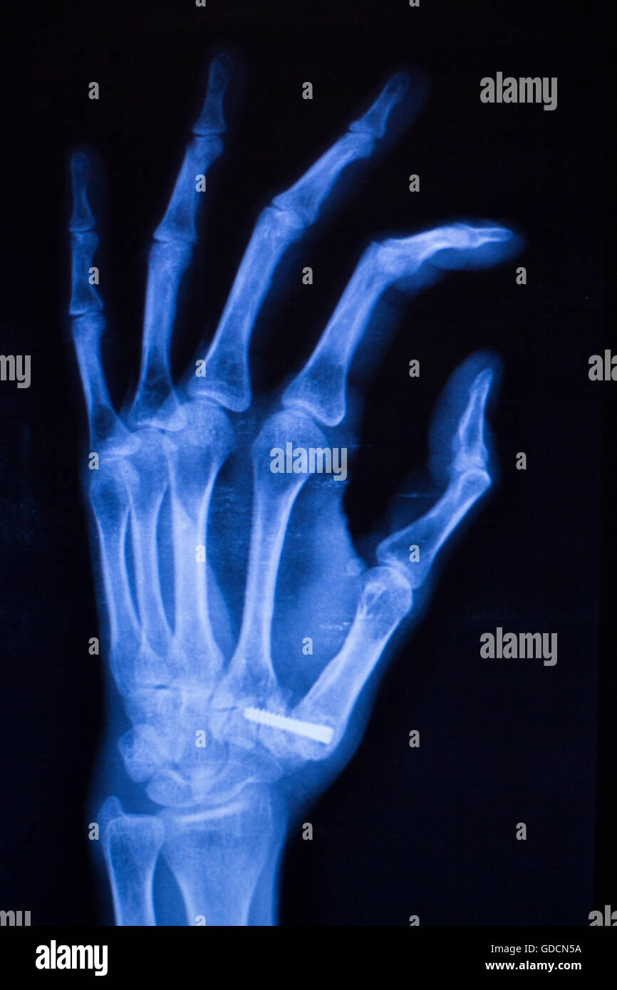 Hand, thumb, wrist and fingers xray traumatology and orthopedics test ...