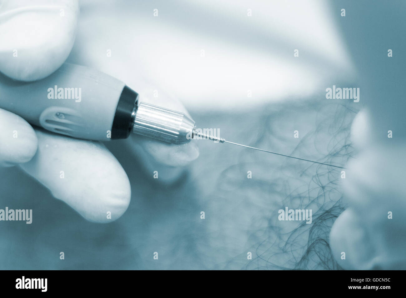 Percutaneous electrical nerve stimulation hi-res stock photography and ...