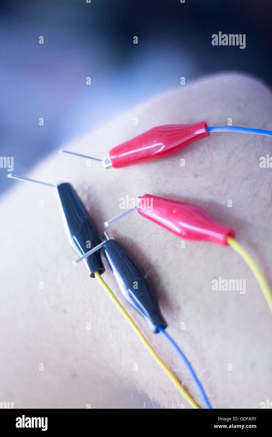 Dry needling electroacupunture needles used by acupunturist ...