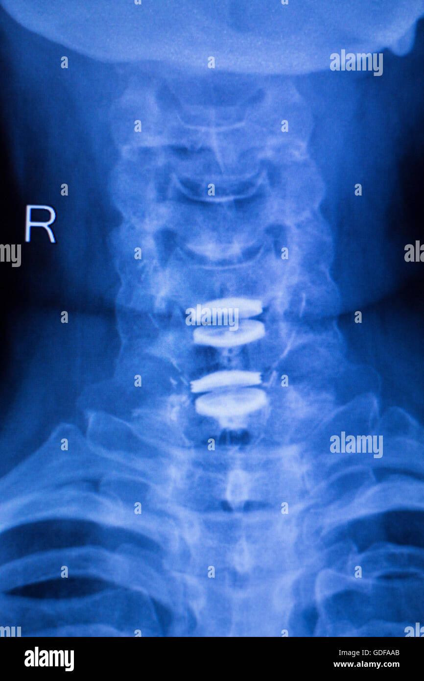 Neck and spine xray traumatology and orthopedics spinal vertebra test ...