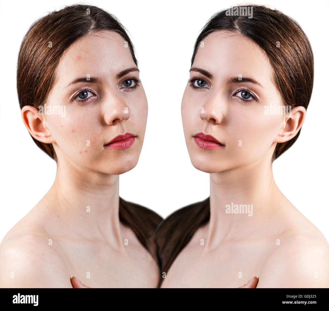 Woman with problem skin on her face before and after treatment isolated ...