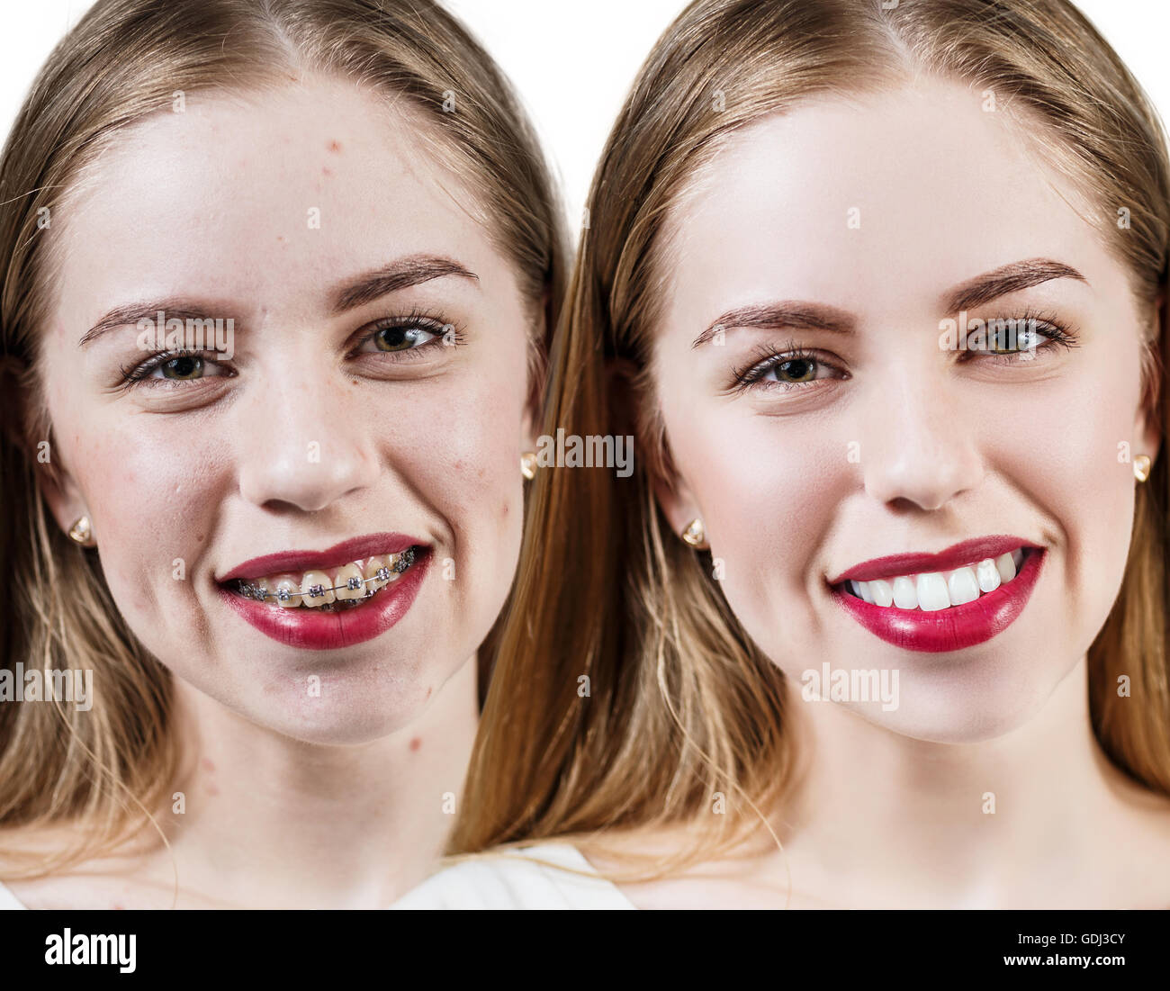 Young woman with perfect teeth before and after braces over white ...