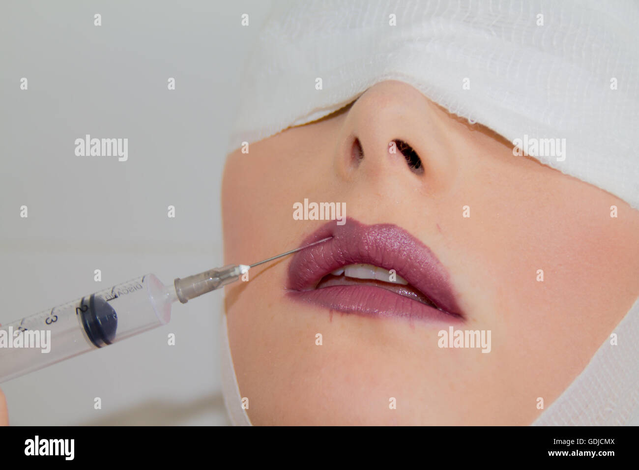 Plastic surgery lip injection face botox Stock Photo - Alamy