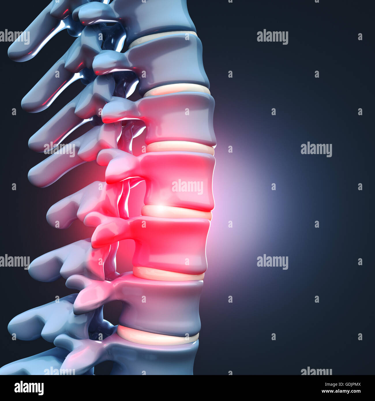 Herniated lumbar disc hi-res stock photography and images - Alamy