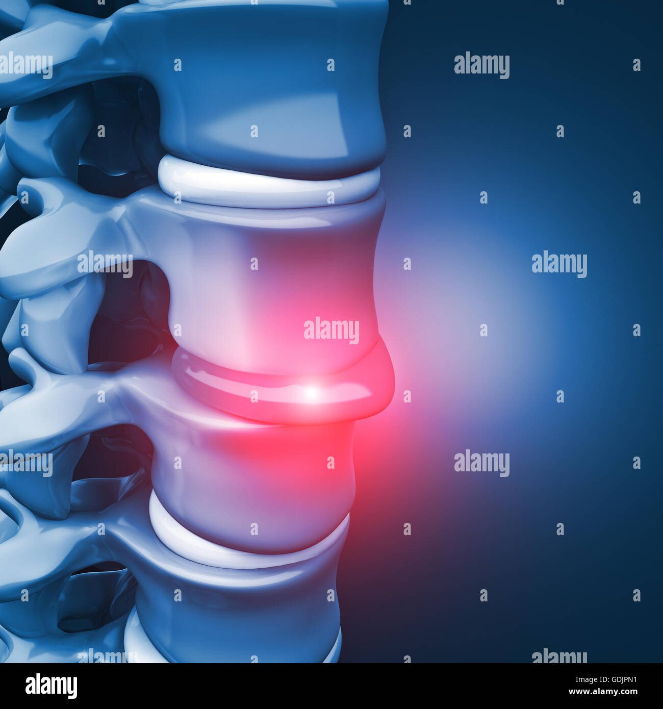 Herniated Lumbar Disc High Resolution Stock Photography and Images - Alamy
