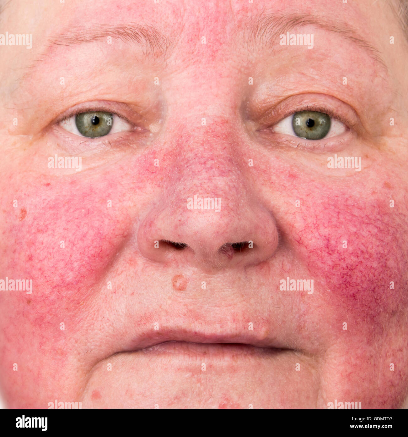 Disease Rosacea High Resolution Stock Photography and Images - Alamy