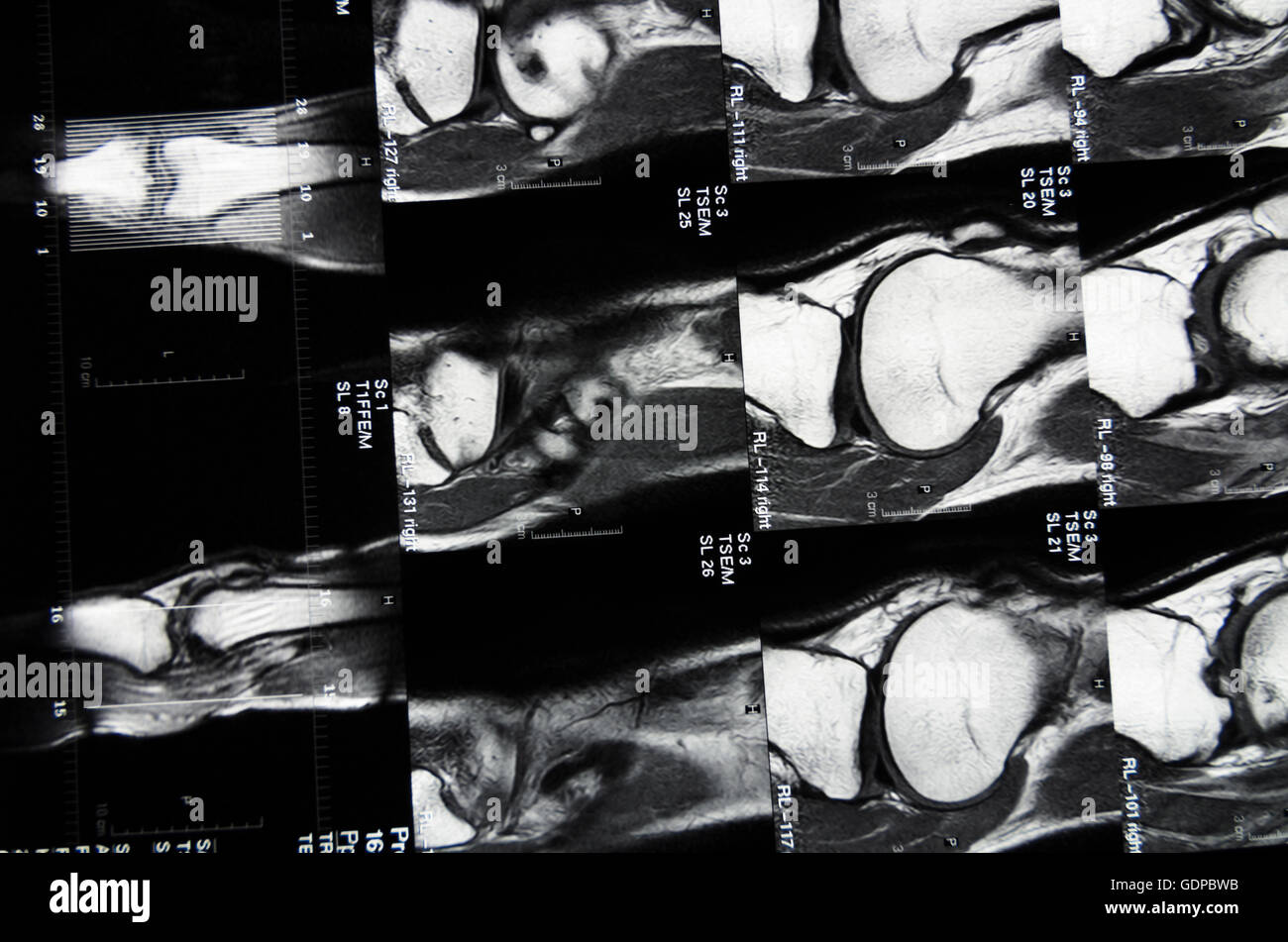 : Magnetic Resonance Imaging ( MRI ) : cross-sectional images of a knee ...