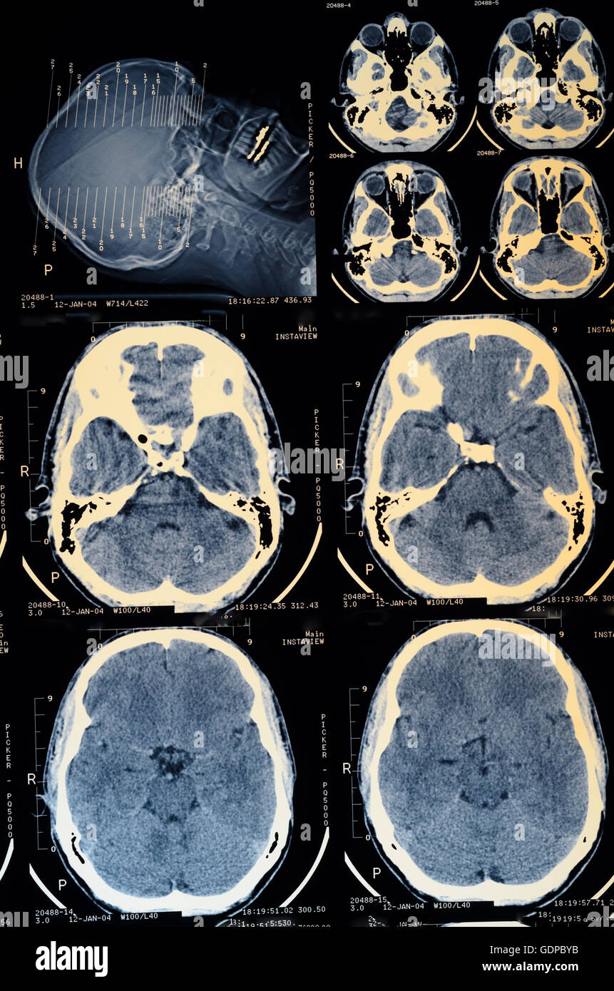 Mri images of the brain hi-res stock photography and images - Alamy