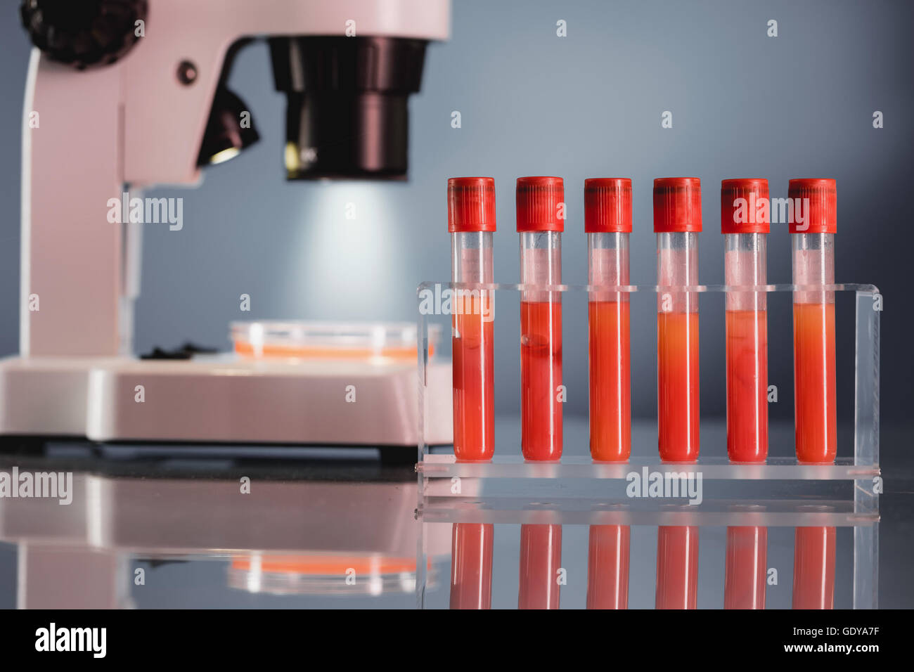 Blood test in medical laboratory, check sugar content diabetes risk ...