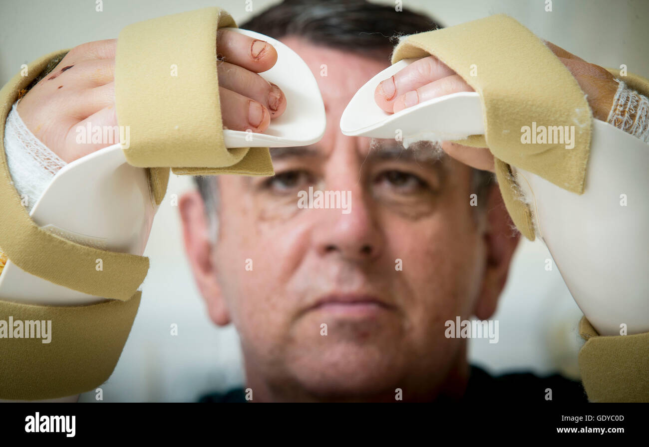 EMBARGOED TO 0001 FRIDAY JULY 22 The UK's first double hand transplant ...