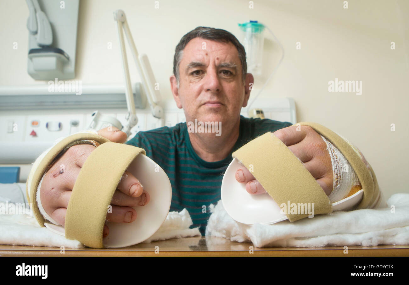 EMBARGOED TO 0001 FRIDAY JULY 22 The UK's first double hand transplant ...