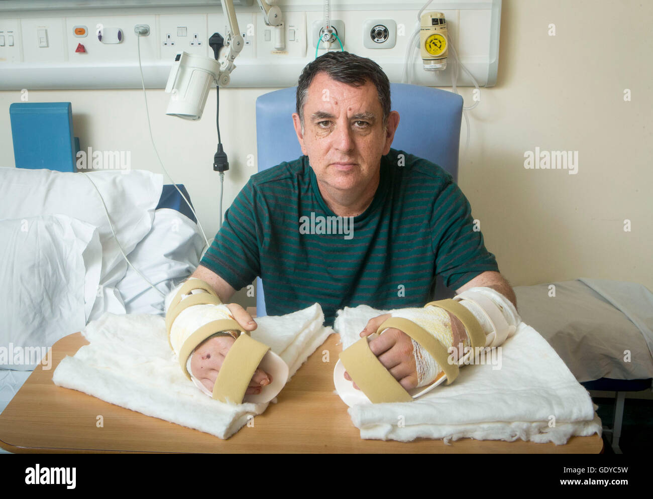 EMBARGOED TO 0001 FRIDAY JULY 22 The UK's first double hand transplant ...