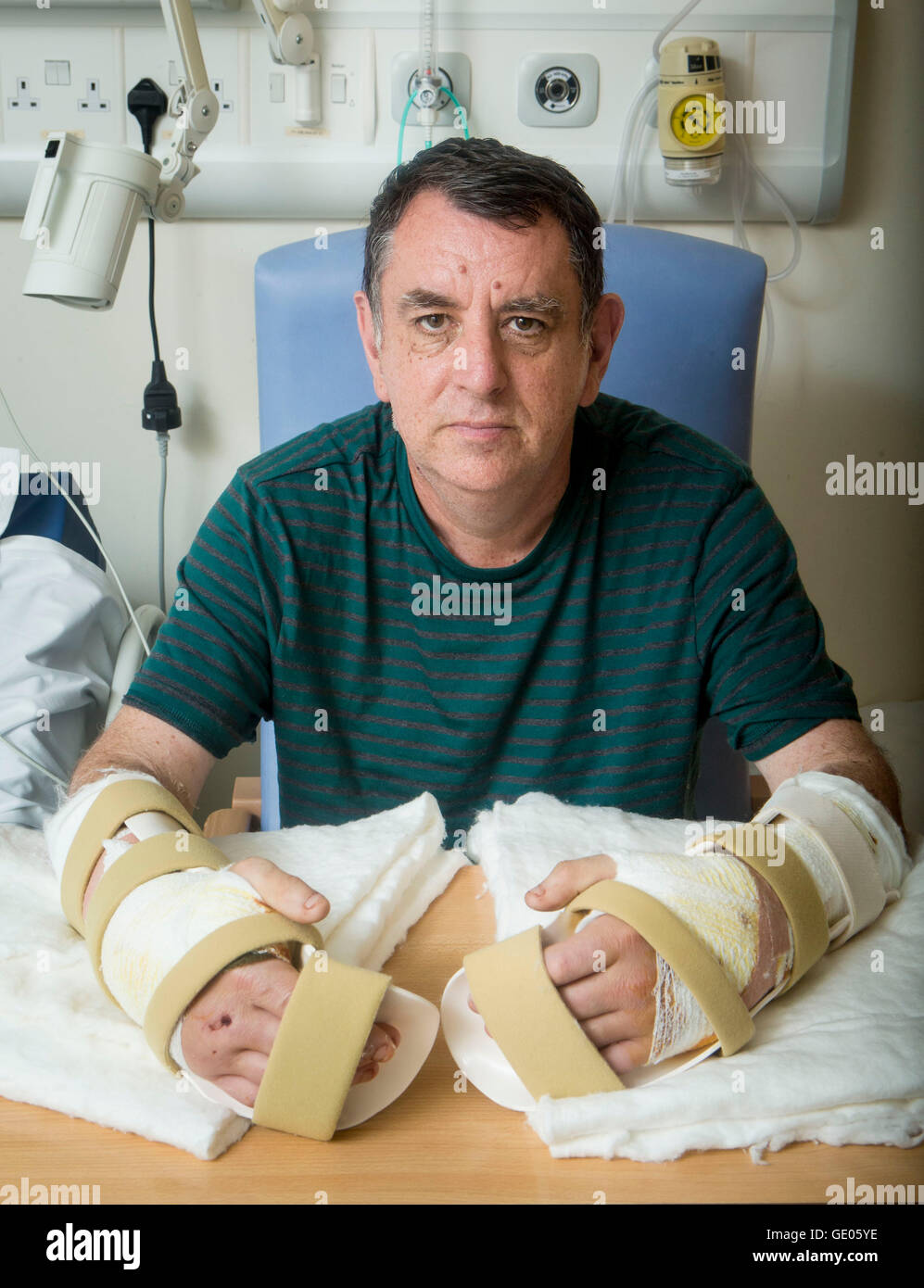 The uks first double hand transplant patient chris king hi-res stock ...