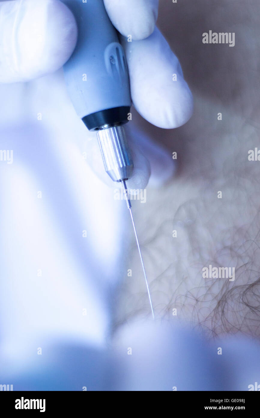 Percutaneous electrical nerve stimulation hi-res stock photography and ...