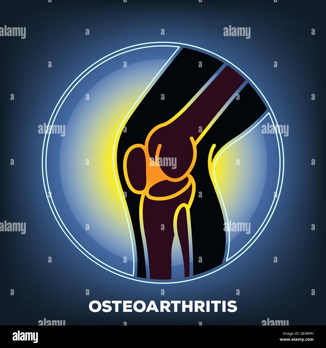 Illustration diagram osteoarthritis Stock Vector Images - Alamy