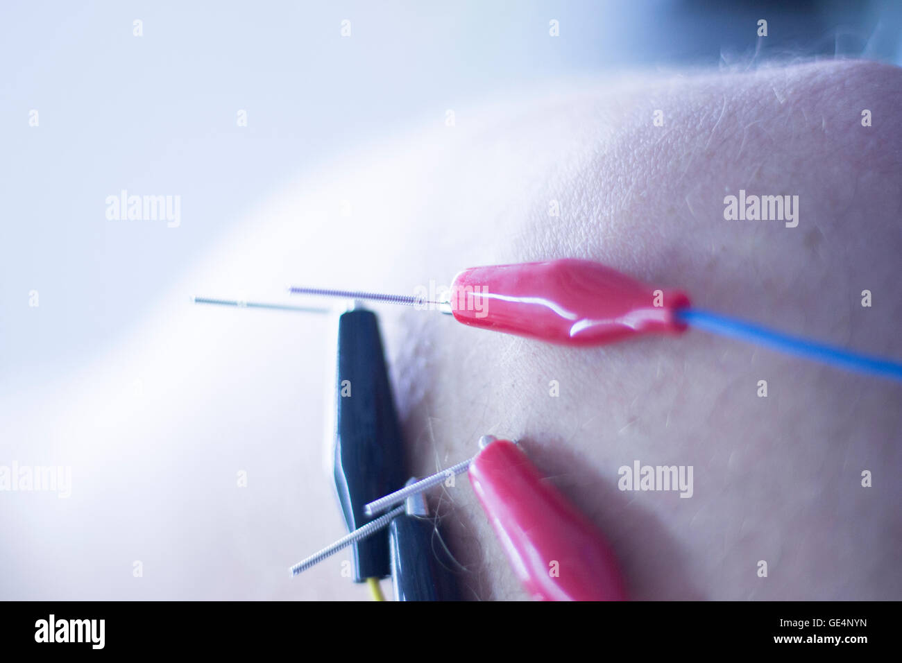 Dry needling electroacupunture needles used by acupunturist ...