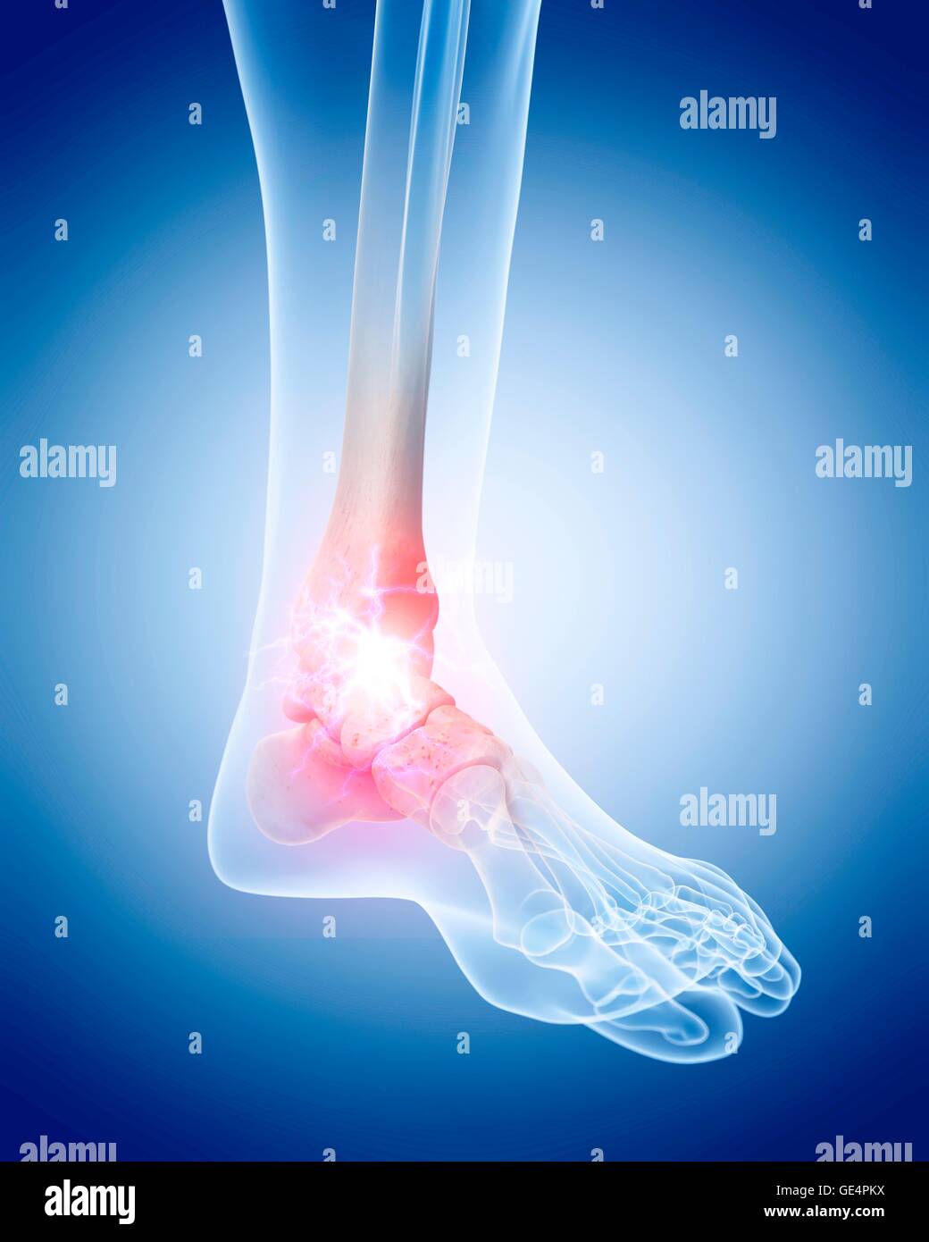 Human ankle pain, illustration Stock Photo - Alamy