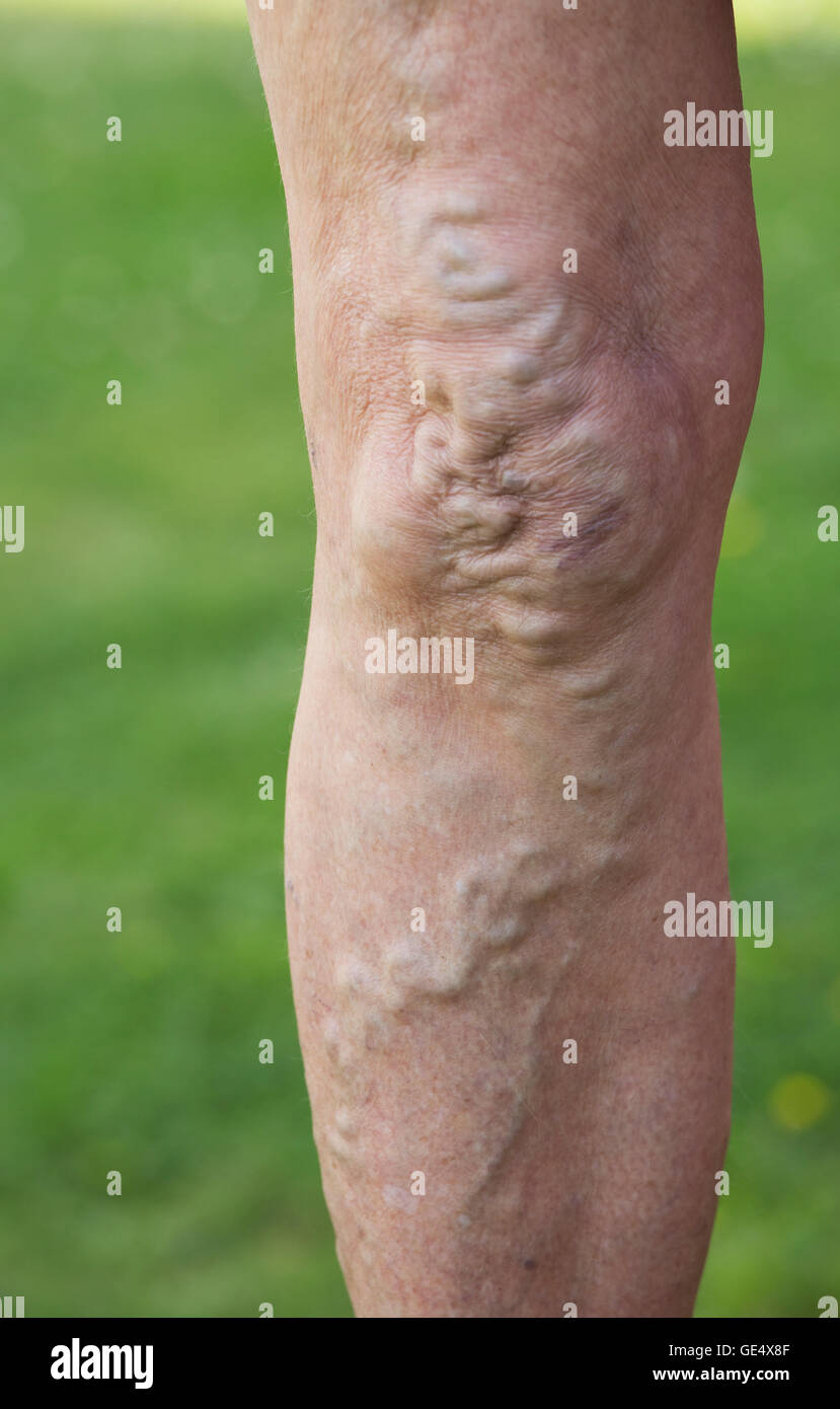 Swollen Knee High Resolution Stock Photography and Images - Alamy