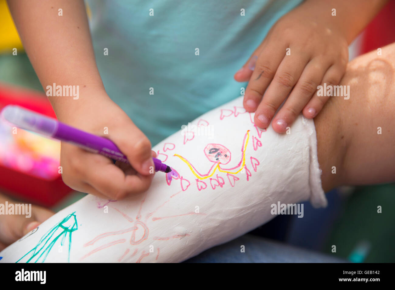 Girl arm plaster cast hi-res stock photography and images - Alamy