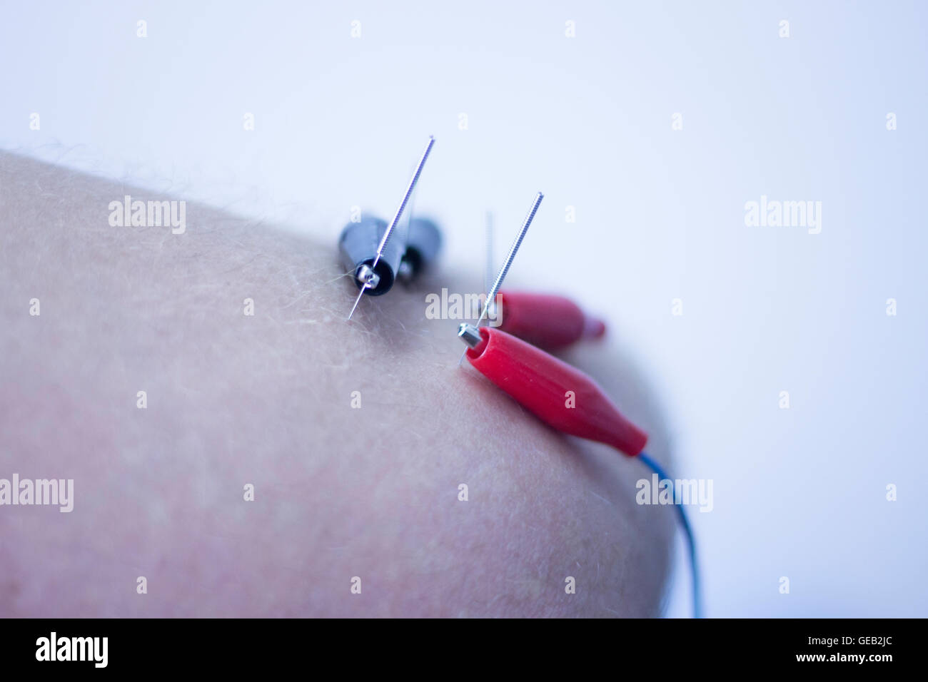 Dry needling electroacupunture needles used by acupunturist ...