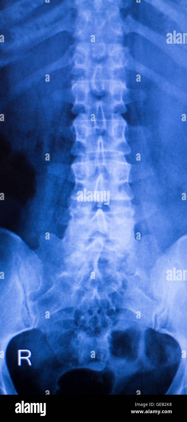 Neck and spine xray traumatology and orthopedics spinal vertebra test ...