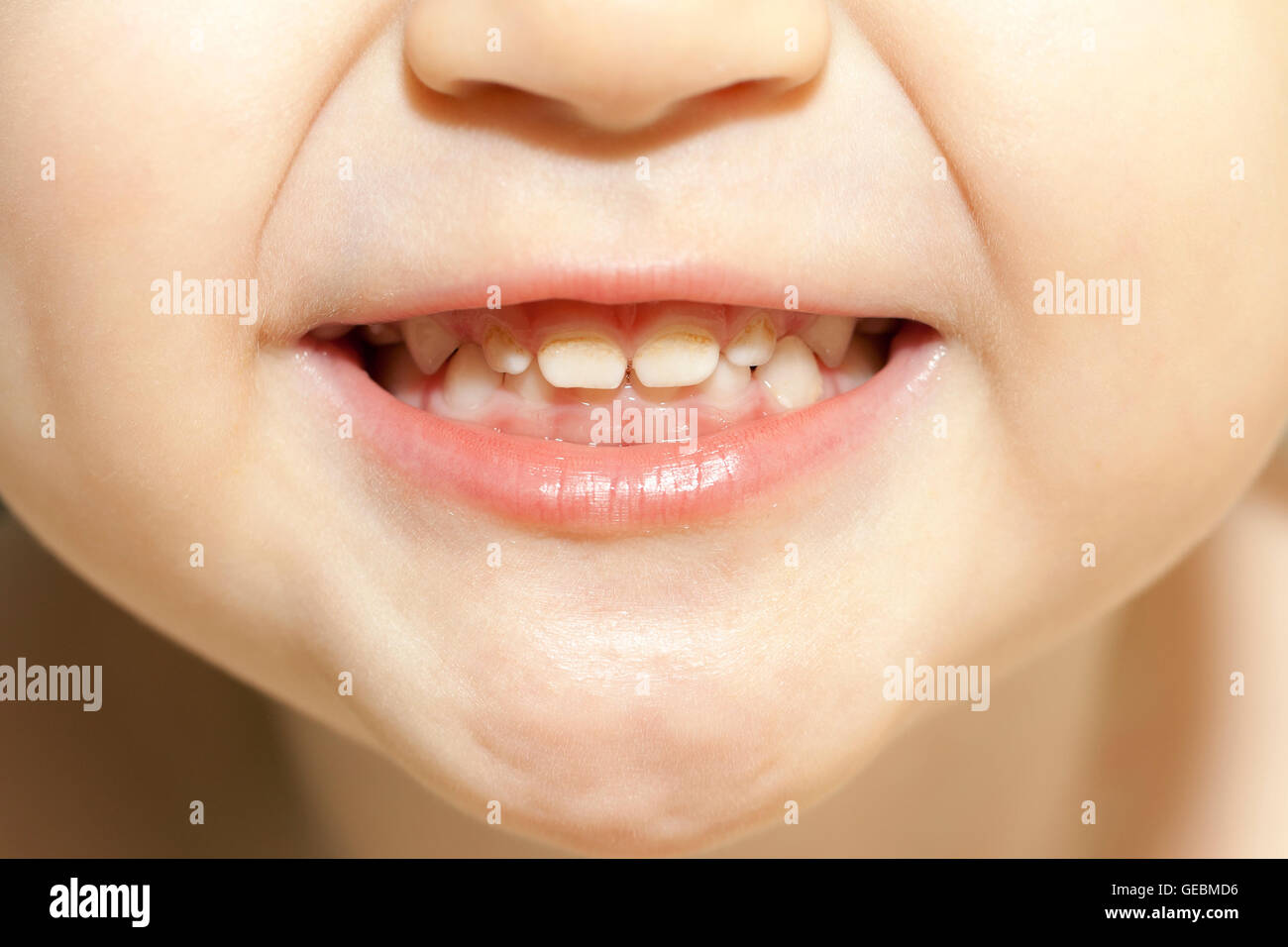 teeth with caries Stock Photo - Alamy