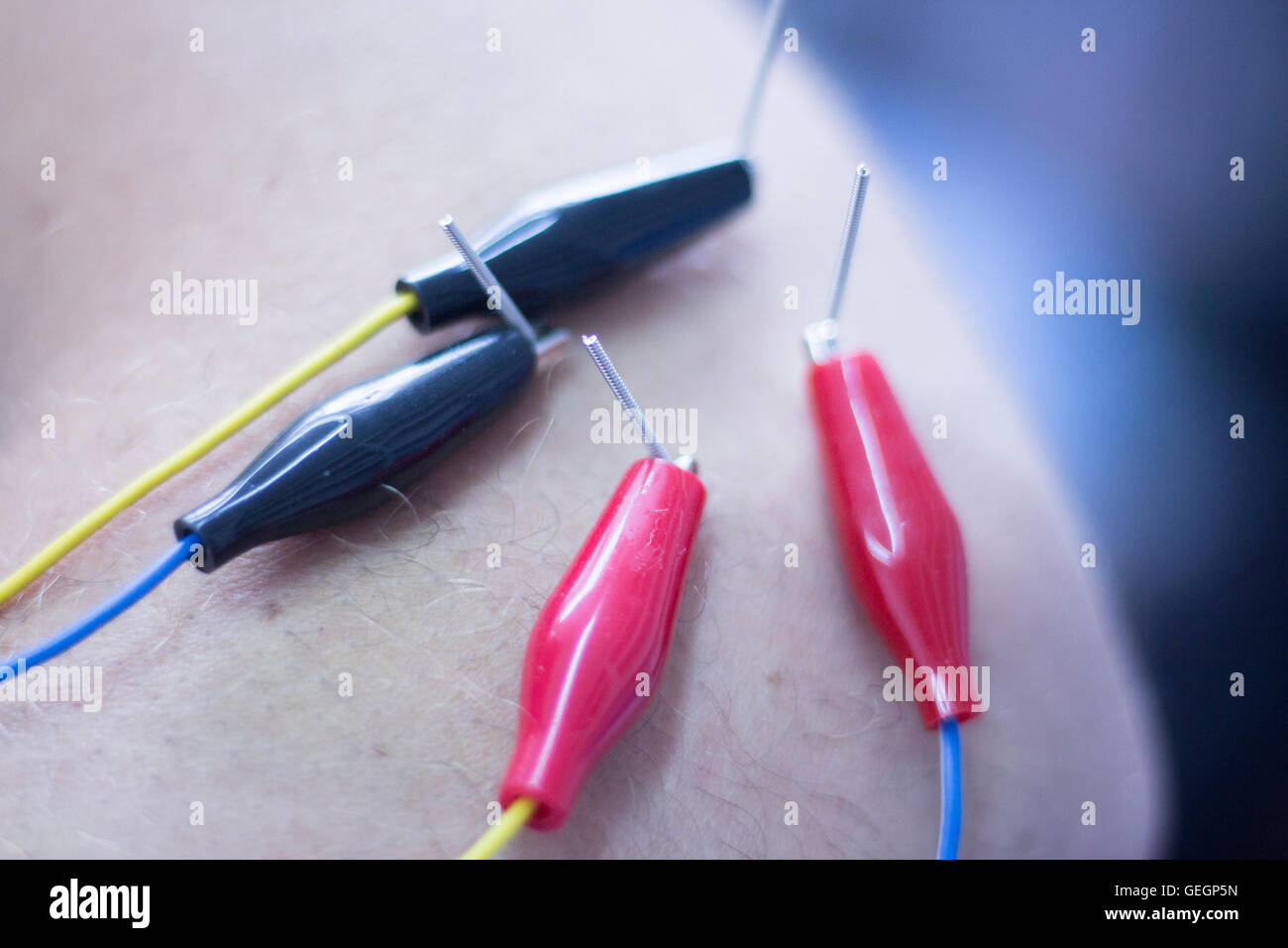 Dry needling electroacupunture needles used by acupunturist ...
