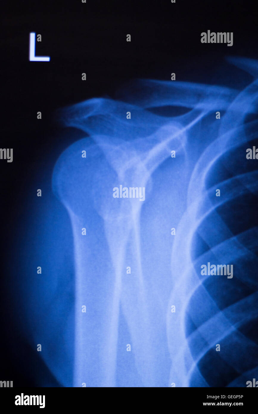 Shoulder joint injury xray traumatology and orthopedics test medical ...