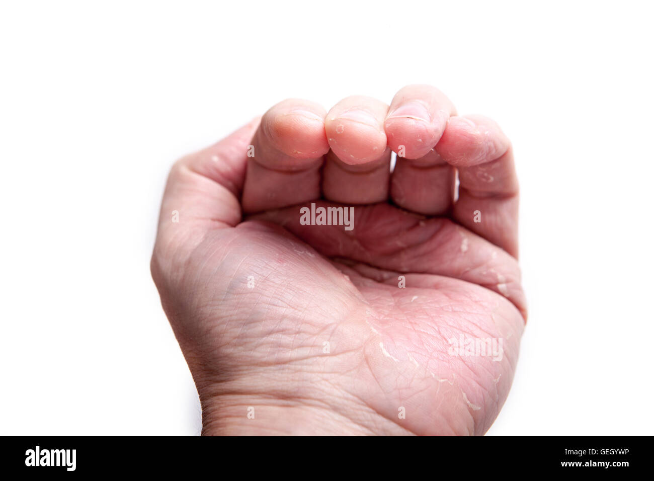 eczema atopic dermatitis symptom skin detail texture Stock Photo - Alamy