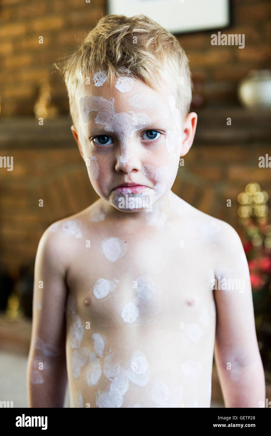 Chicken pox hi-res stock photography and images - Alamy