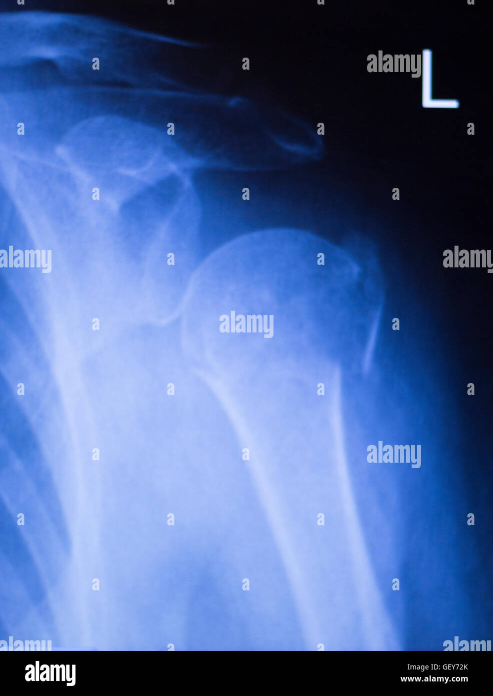 Shoulder joint injury xray traumatology and orthopedics test medical ...