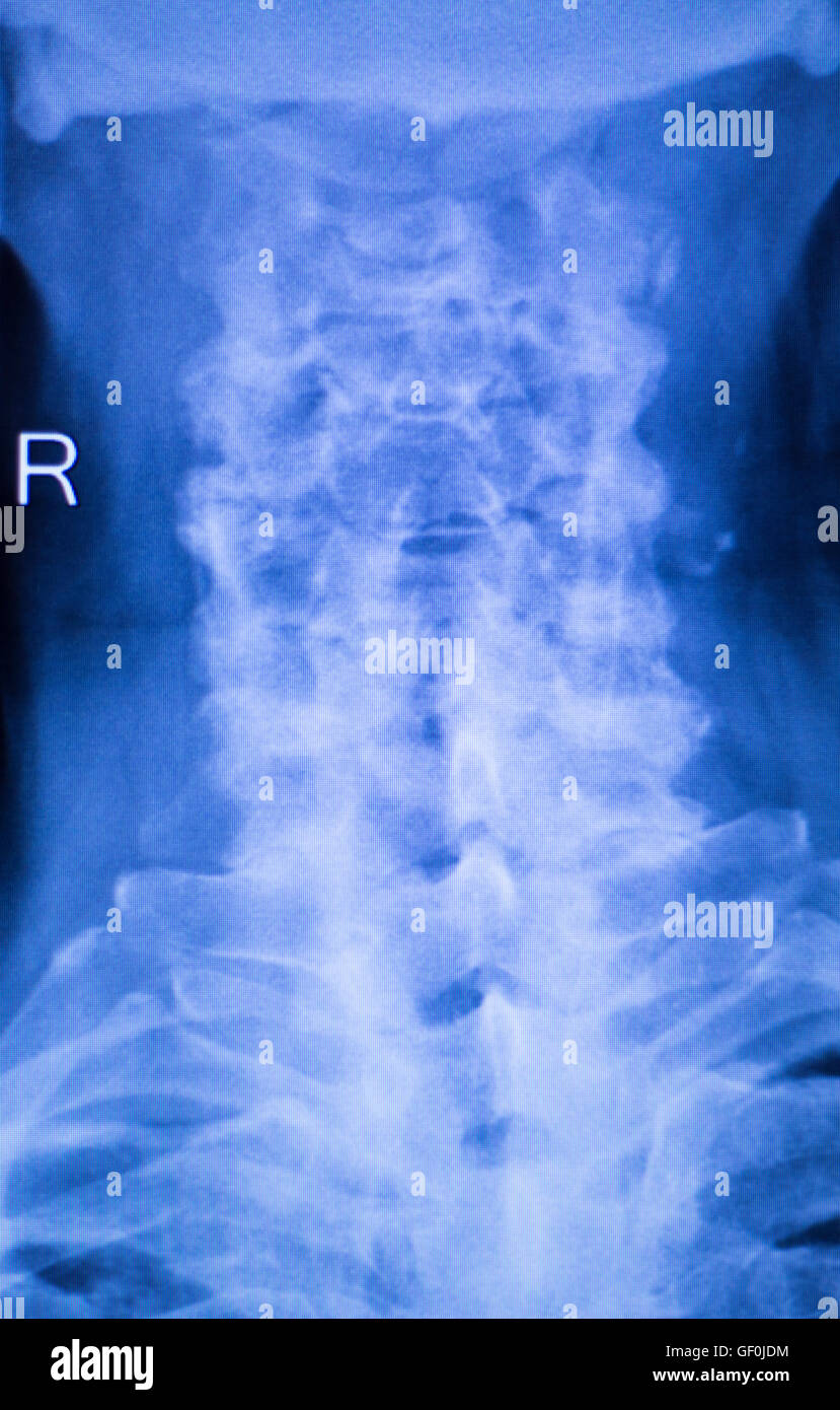 Neck and spine xray traumatology and orthopedics spinal vertebra test ...