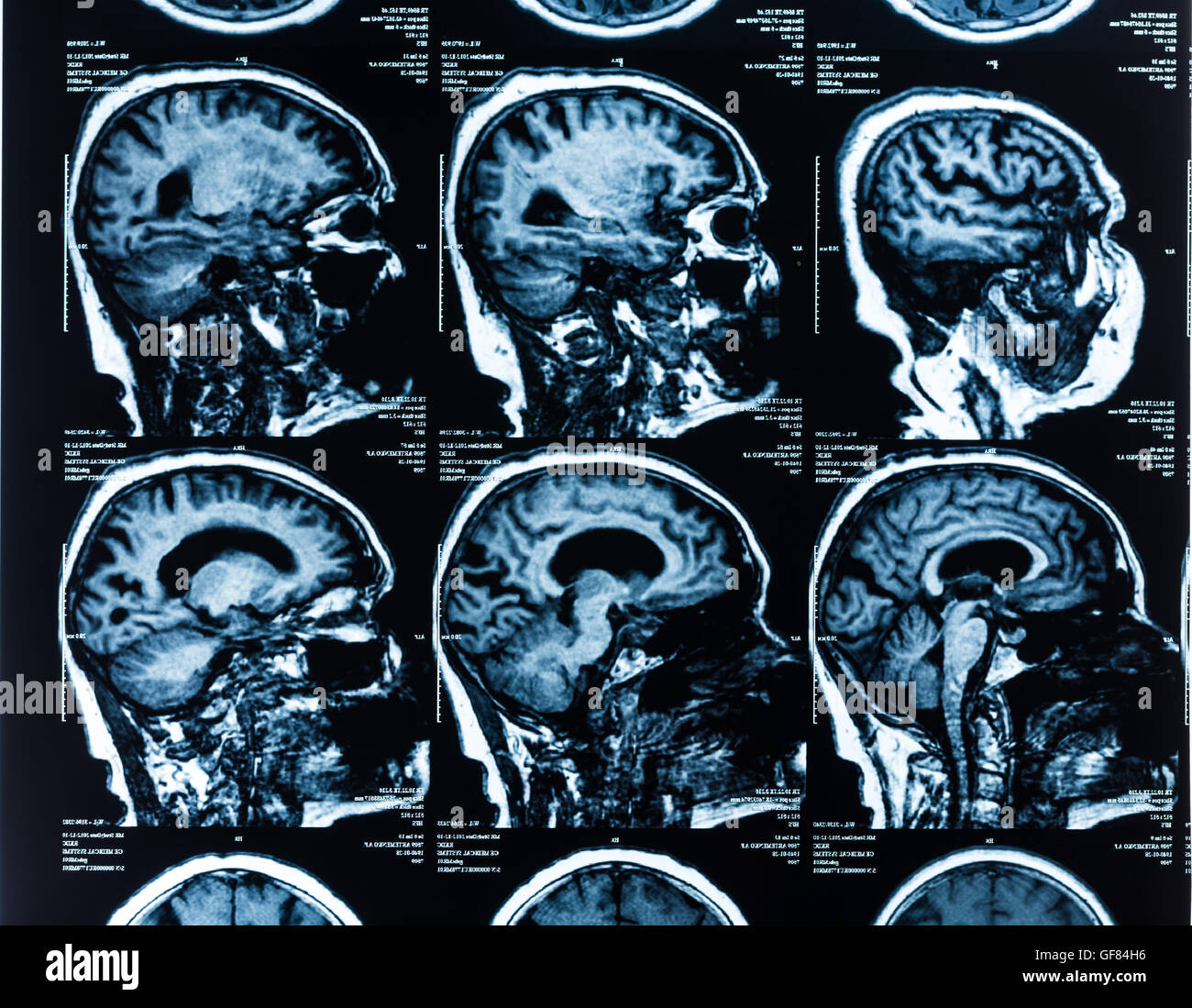 MRI Head Scan Stock Photo - Alamy