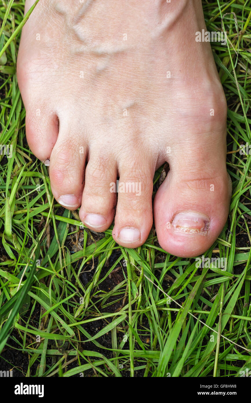 Bruised toe hi-res stock photography and images - Alamy