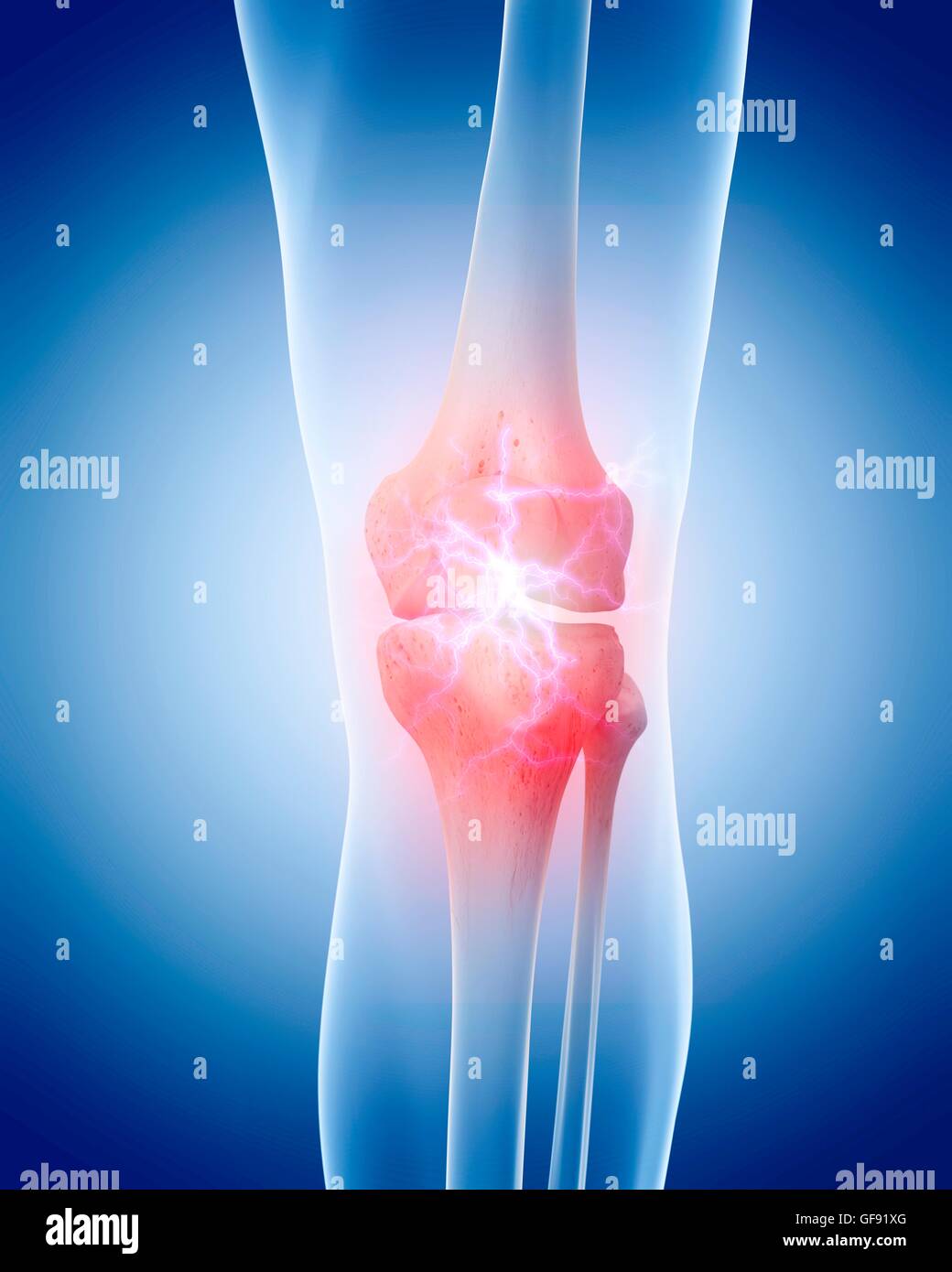 Human knee pain, illustration Stock Photo - Alamy