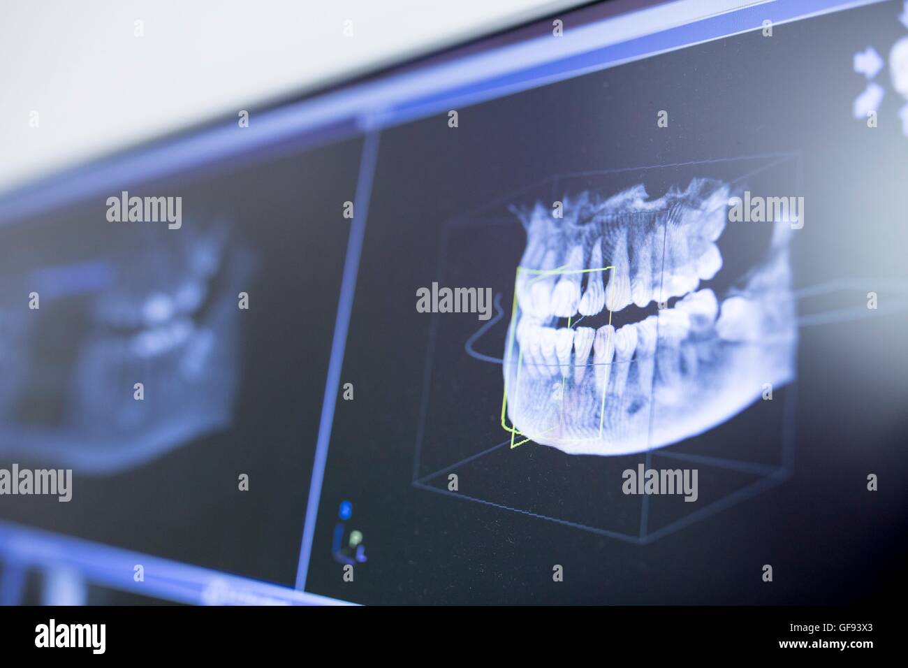 Healthy teeth x ray hi-res stock photography and images - Alamy
