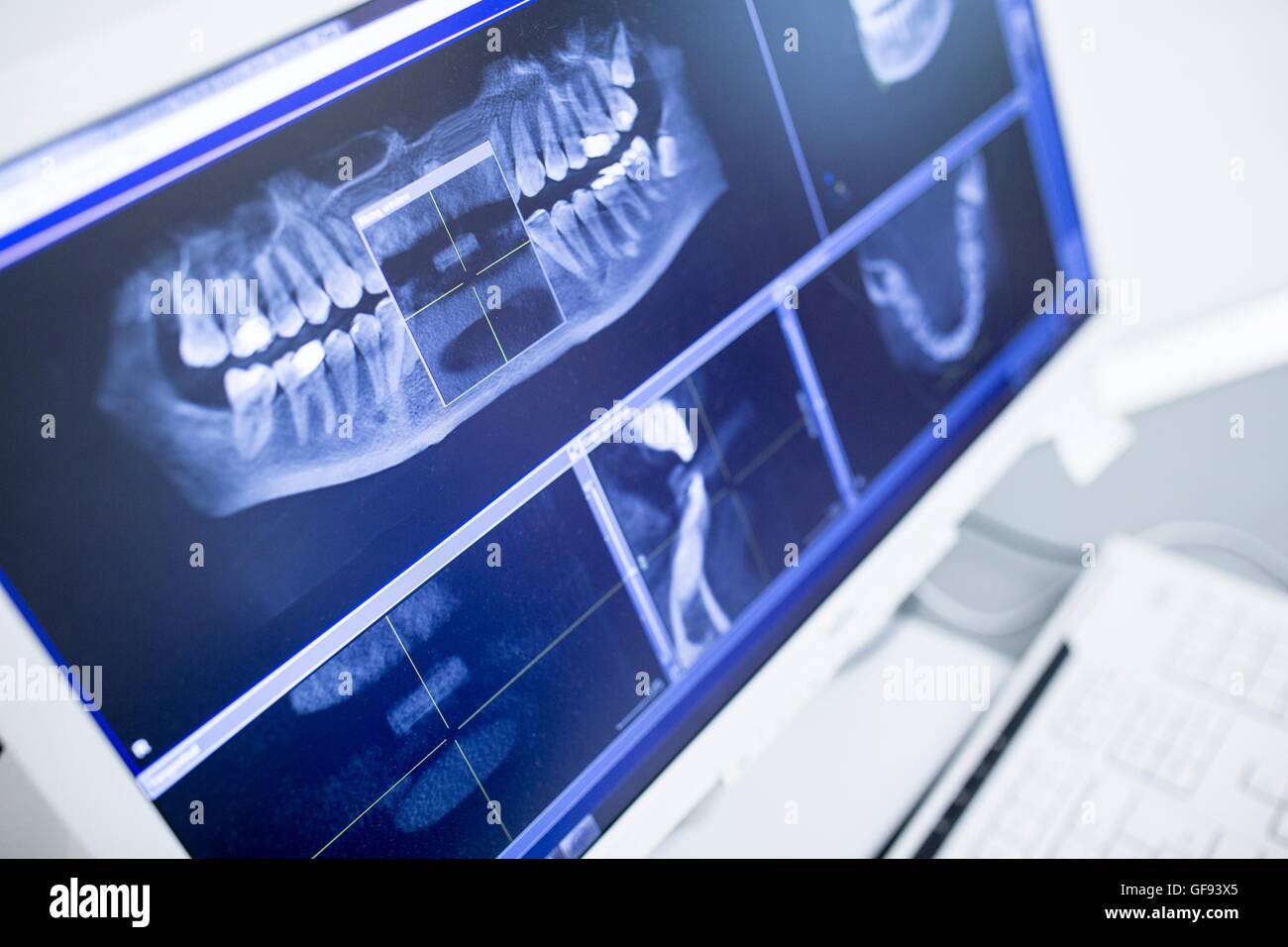 Close-up of teeth x-ray display on monitor screen in dentist clinic ...