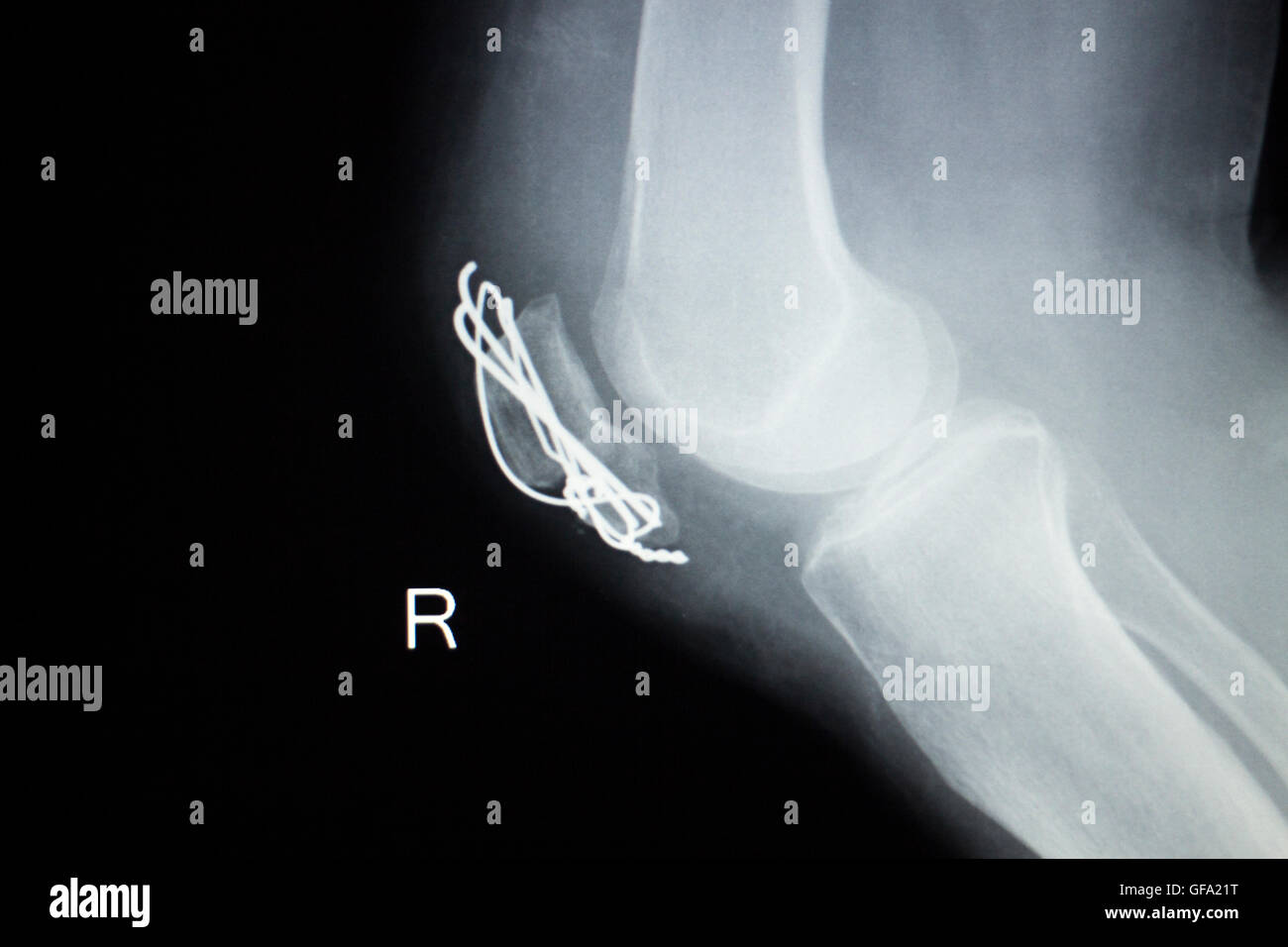 Knee joint wire orthopedic titanium metal Traaumatology ball and socket ...