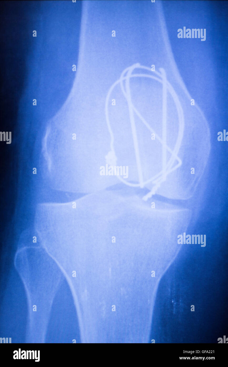 Knee joint wire orthopedic titanium metal Traaumatology ball and socket ...