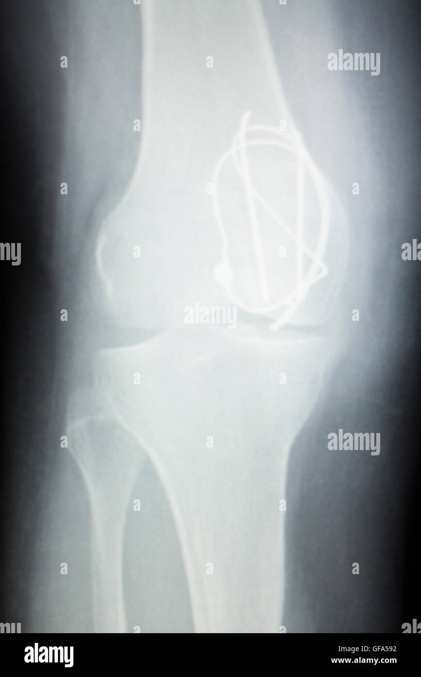 Knee joint wire orthopedic titanium metal Traaumatology ball and socket ...