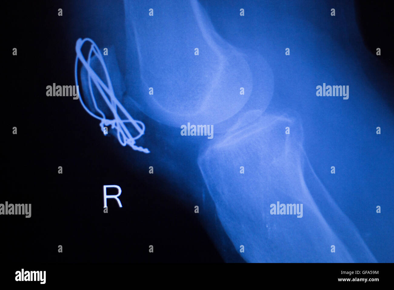 Knee joint wire orthopedic titanium metal Traaumatology ball and socket ...