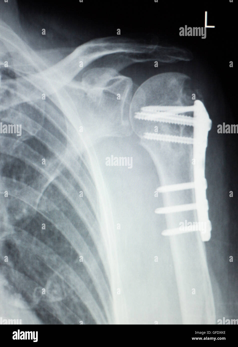 Shoulder joint replacement orthopedic titanium metal Traaumatology ball ...