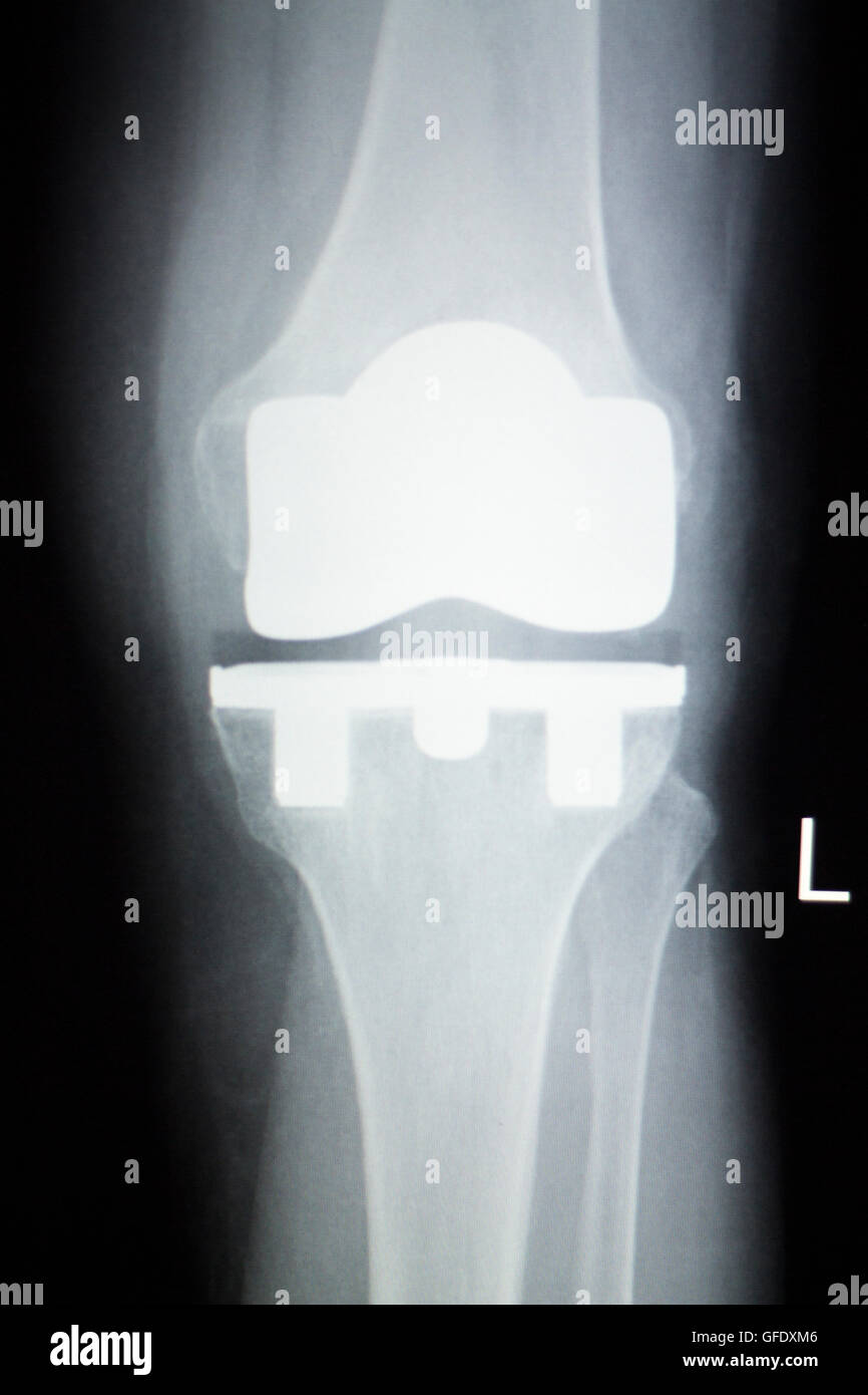 Knee joint replacement orthopedic titanium metal Traaumatology ball and ...