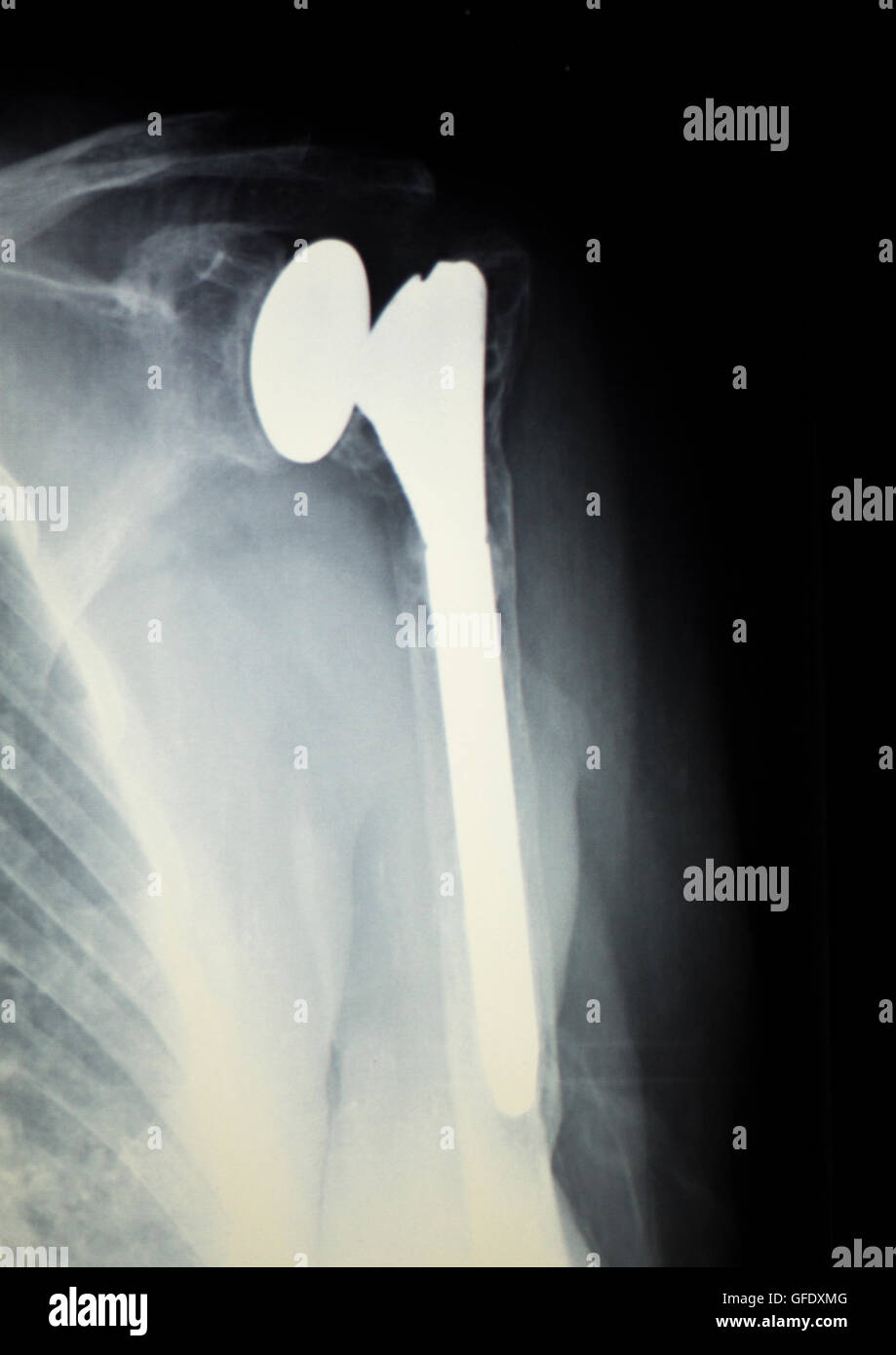 Shoulder joint replacement orthopedic titanium metal Traaumatology ball ...